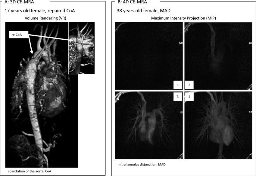 Pediatric Cardiology and Cardiac Surgery 41(1): 28-41 (2025)